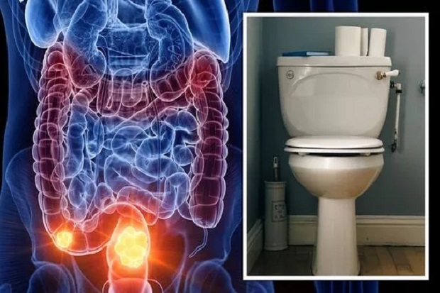 Menurut Dokter Gejala Kanker Usus, Bisa Dilihat Bentuk dan Warna Feses ...